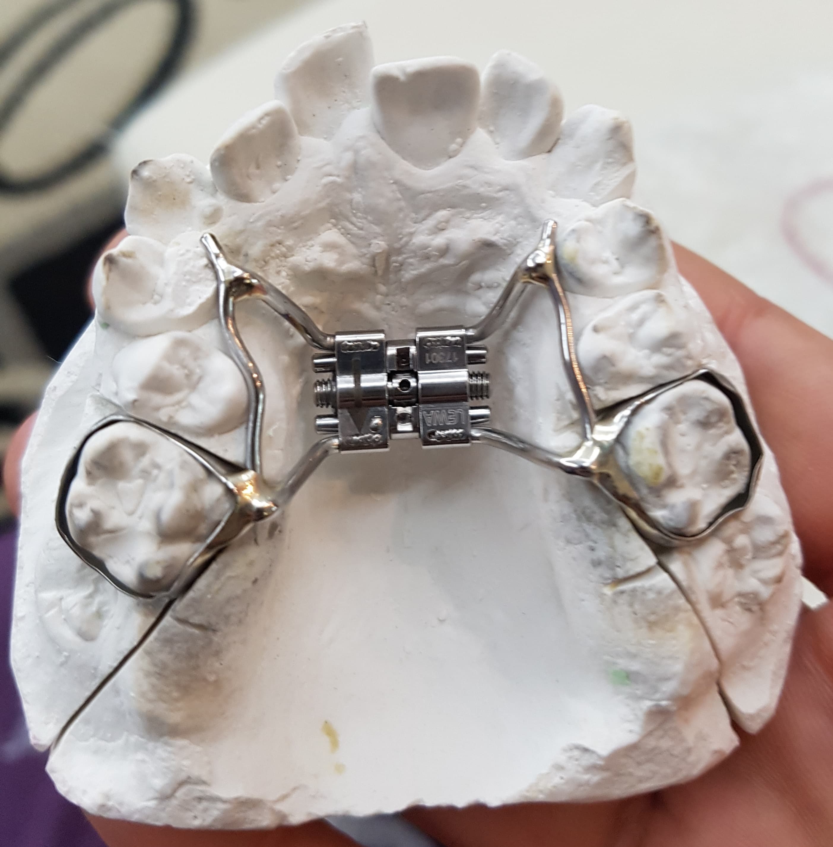 Folosirea unui disjunctor maxilar este indicata la copiii la care ...